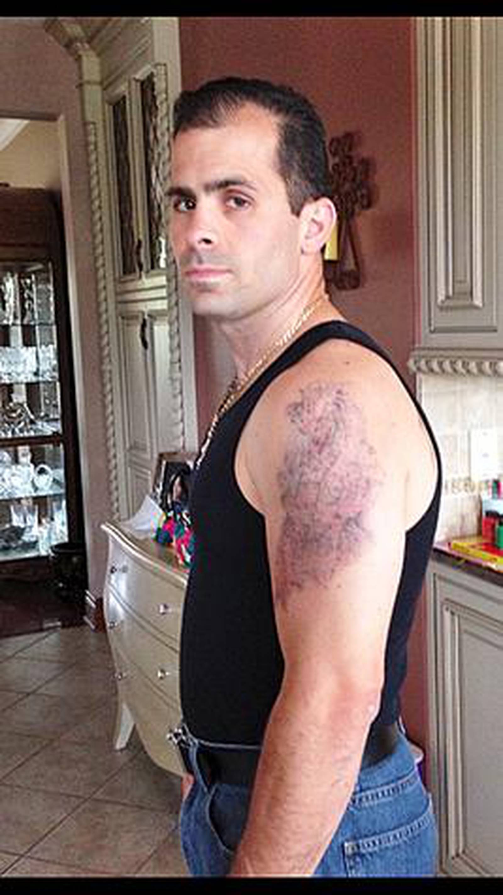 With new methods, more tattoos come off – Shaw Local