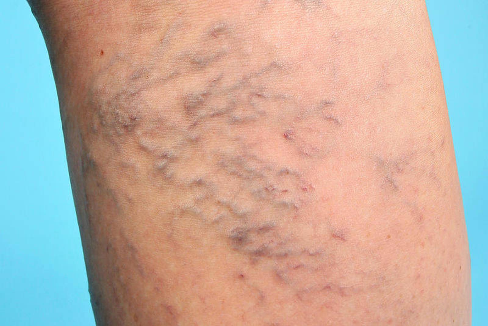 Veins, veins, go away: Annoyed by that purple spiderweb on your legs ...